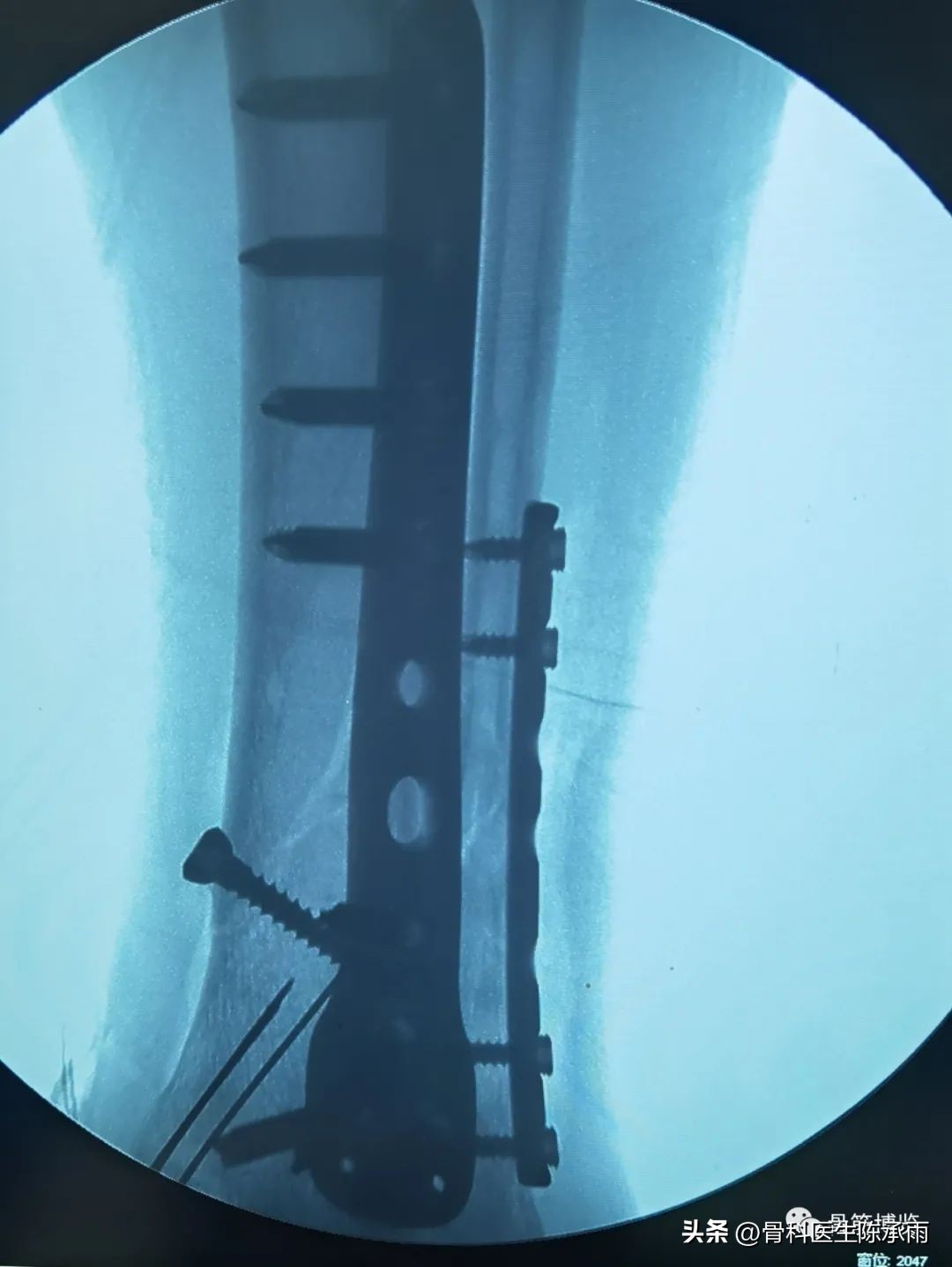 How to deal with poor skin conditions for distal tibia and fibula ...