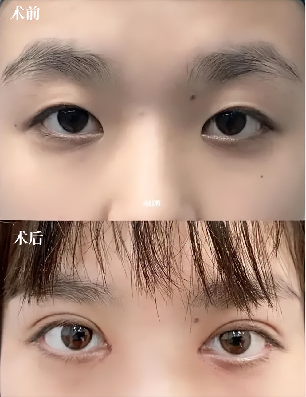What is Japanese double eyelid - iNEWS