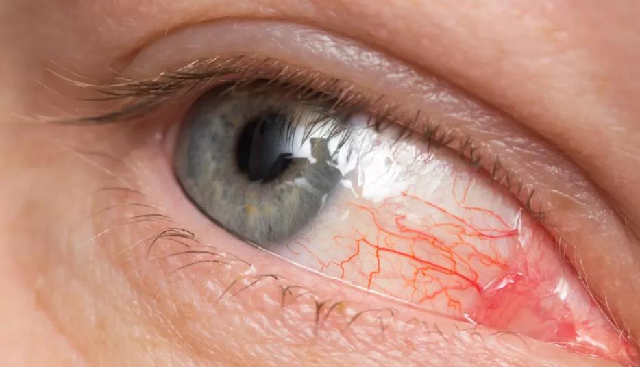 Itchy eyes, red blood streaks, can it be conjunctivitis? - iNEWS