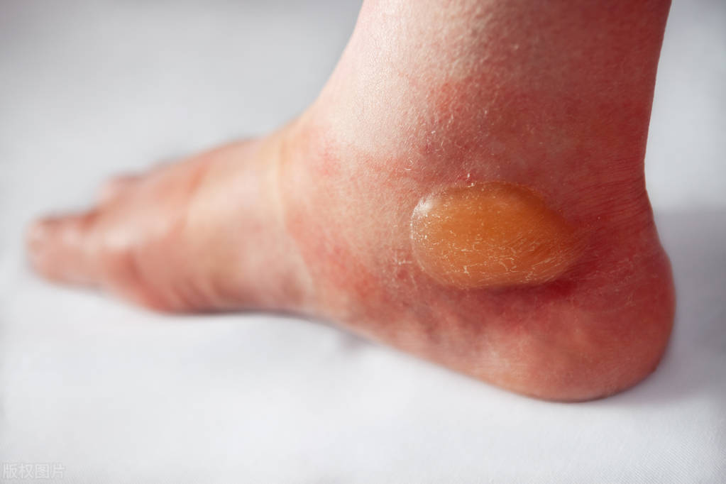 Do you need to pop the blisters after the burn? How to avoid infection ...