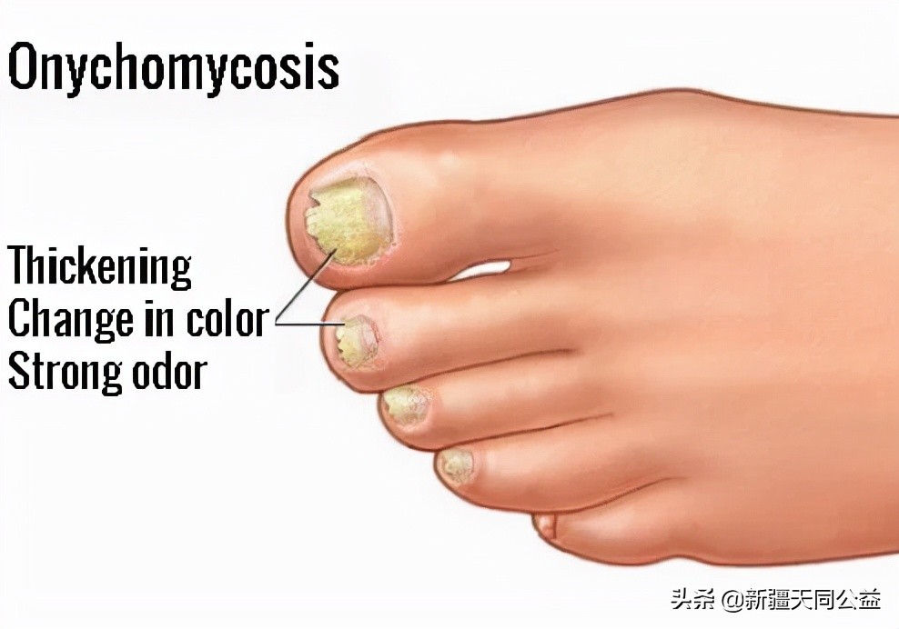 Understand the nail changes caused by AIDS - iNEWS