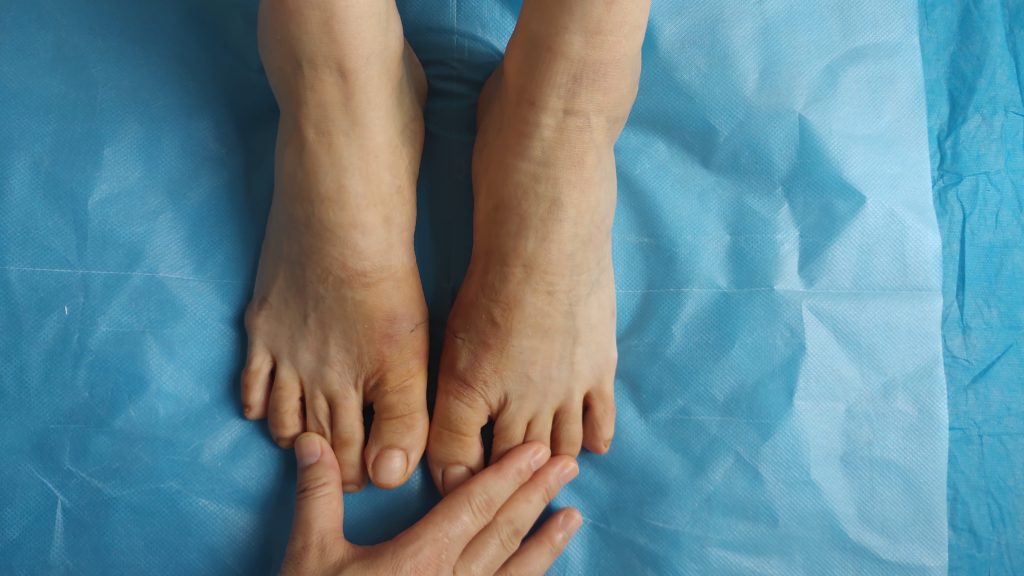 How does hallux valgus develop, and the development trend of the big ...