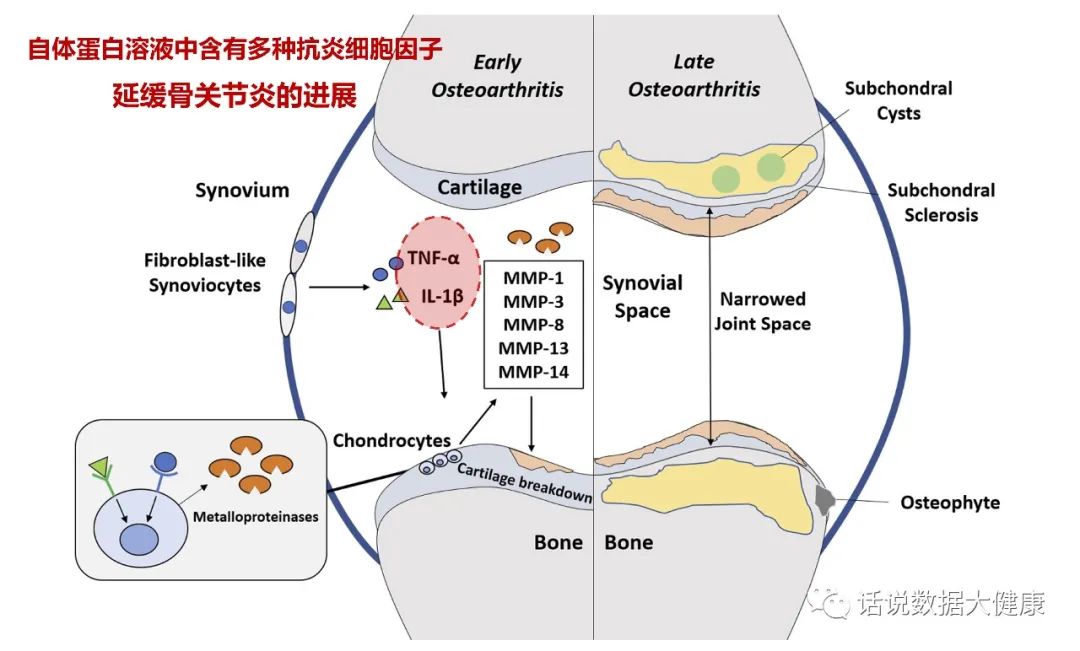 Autologous protein injection, an early solution for osteoarthritis? - iNEWS