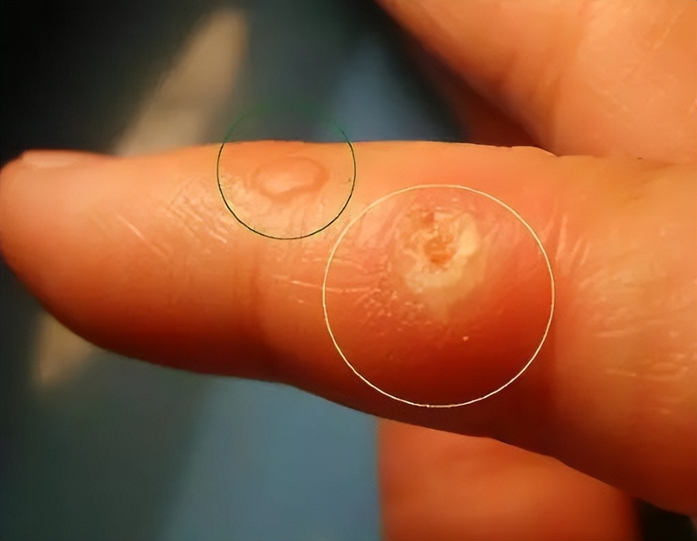 This kind of "meat bump" grows on the body, what does it mean? - iNEWS