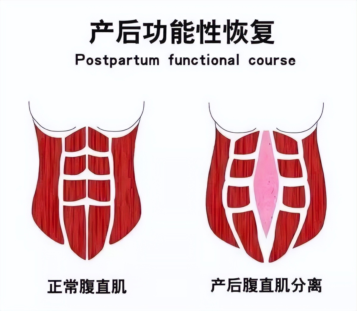 How is rectus abdominis separation treated?How to adjust?One article ...
