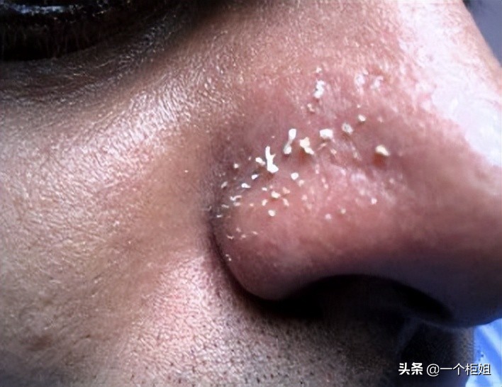 What is the white stuff that sticks out of the nose? - iNEWS