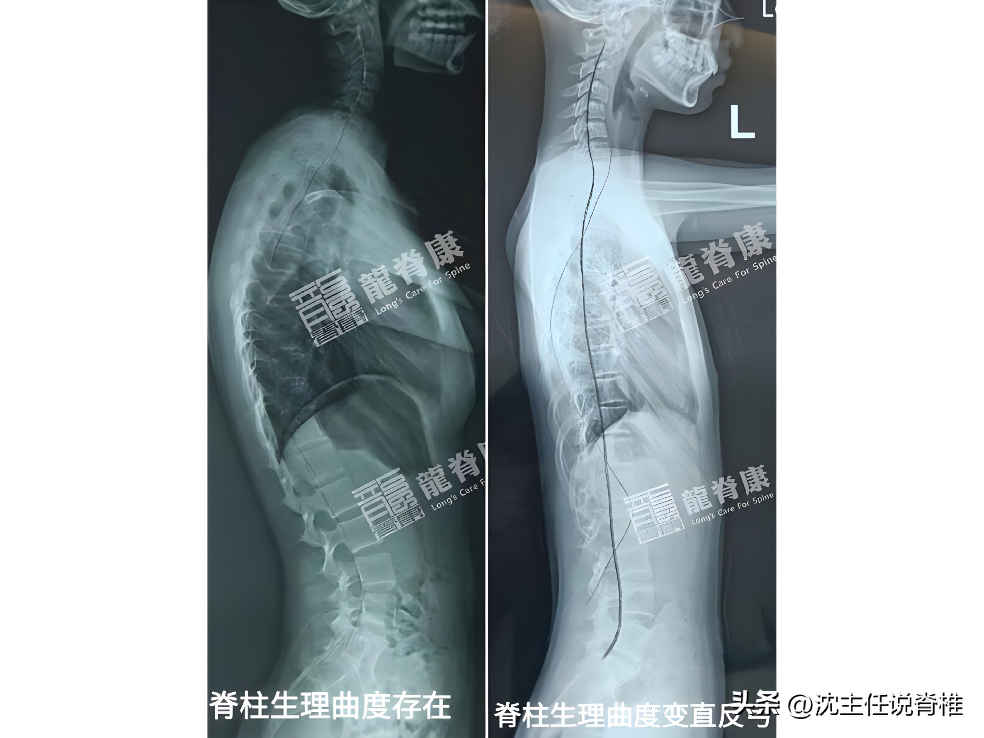 Physiological curvature becomes straight, reverse bow, what is going on ...