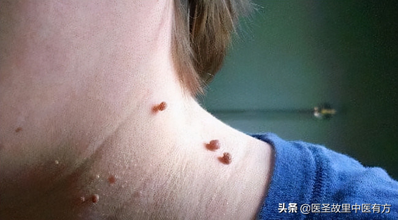 The famous traditional Chinese medicine for polyps - Jisheng Wumei Pill ...