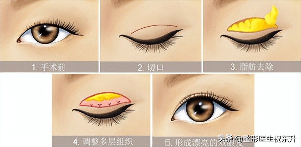 Take a look at the indications of "eyebrow lifting, double eyelid ...