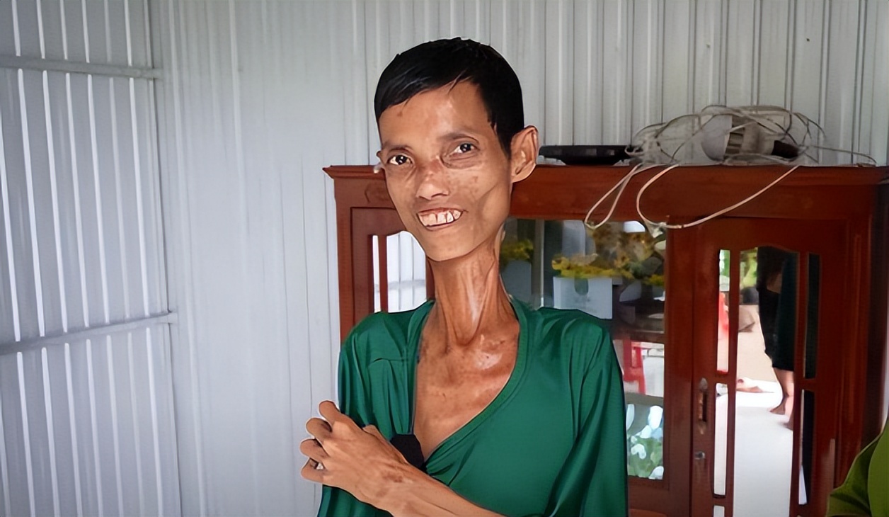 How scary can anorexia be? A man who is 1.78 meters tall weighs only 39 ...