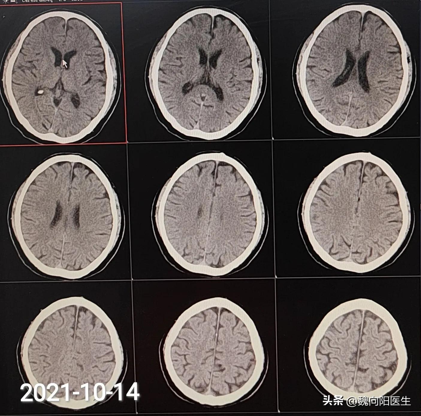 How long does it take for a brain tumor to grow from scratch?Is it a ...