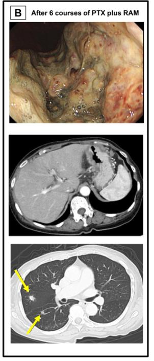 Gastric cancer is inoperable at the advanced stage. This therapy ...