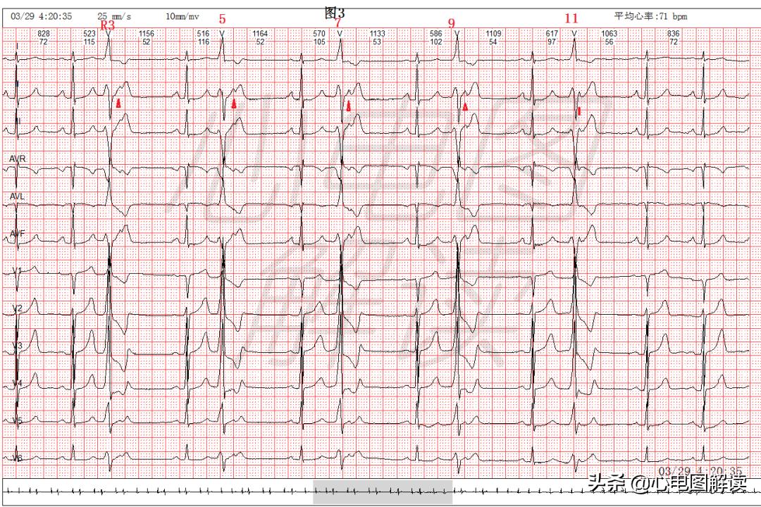 The complex relationship between premature ventricular contractions and ...