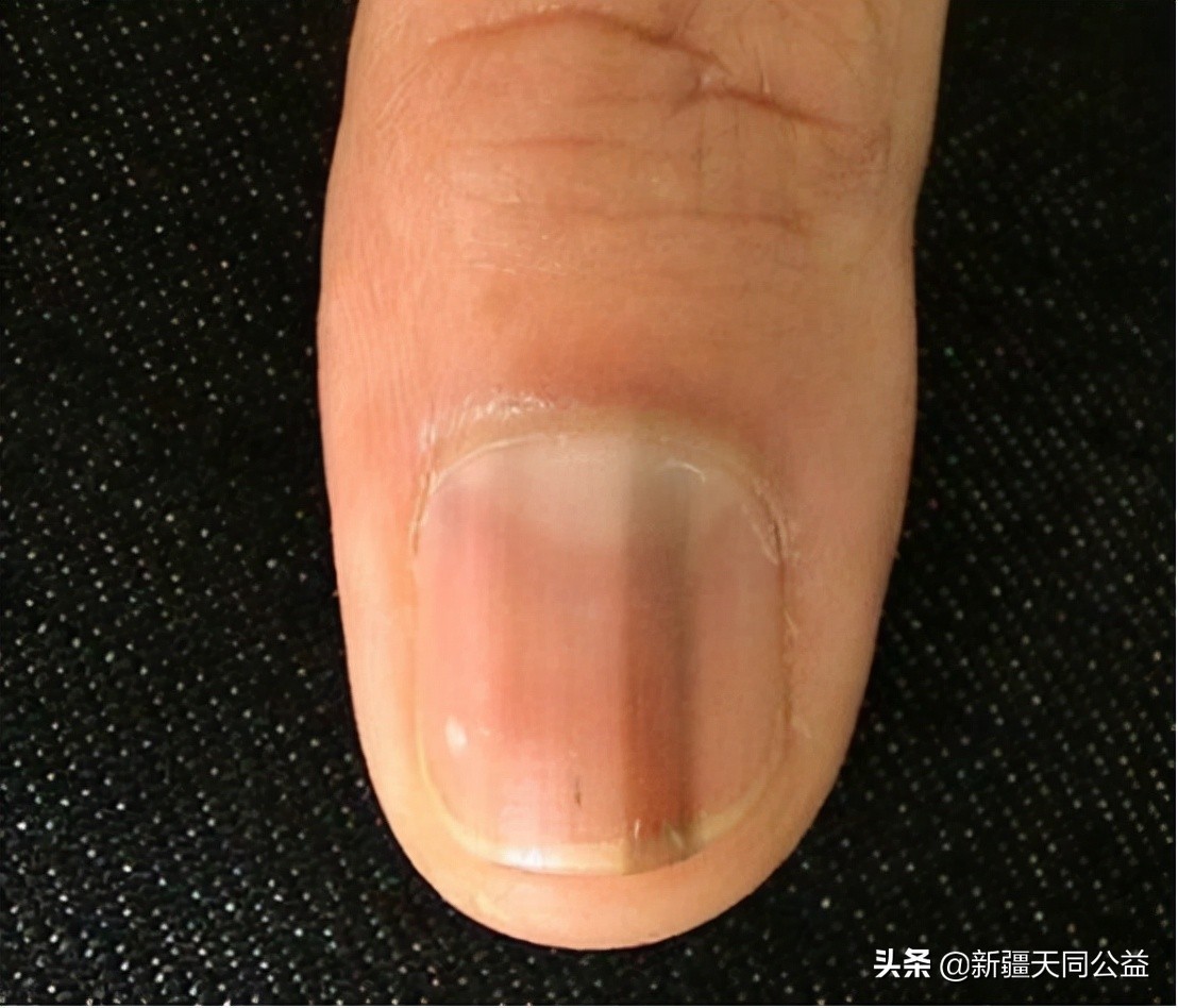 Understand the nail changes caused by AIDS - iNEWS