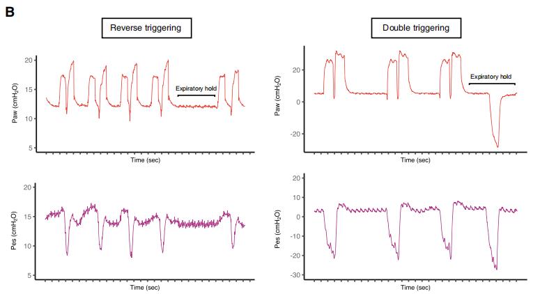 Professor Luo Hong: How to identify "reverse trigger" during mechanical ventilation and view its ...