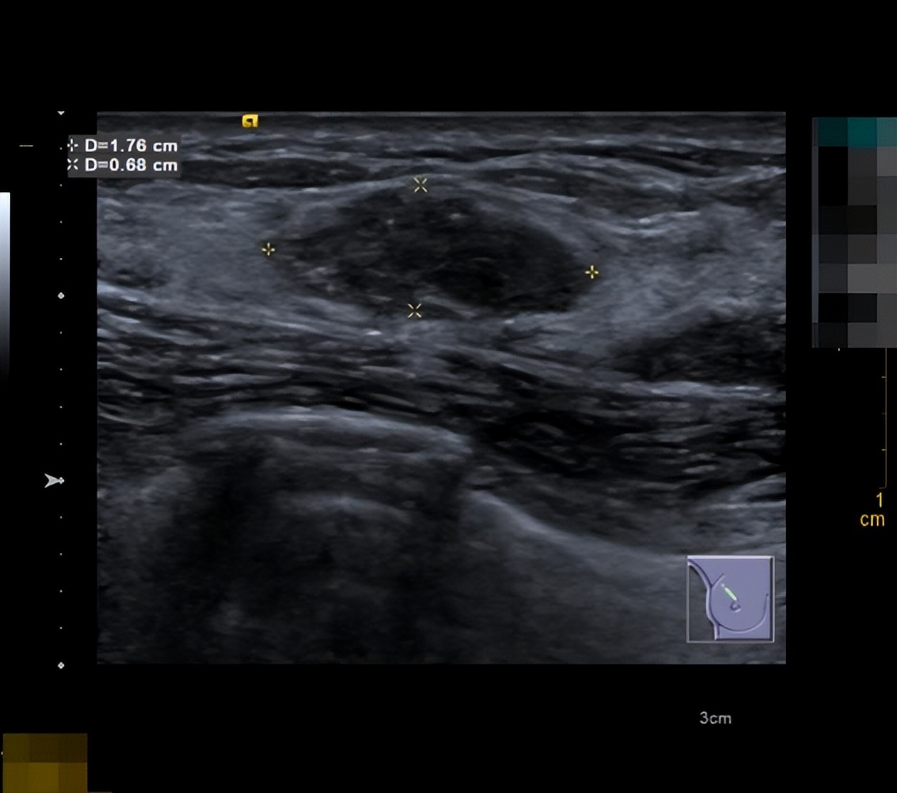 Lobular carcinoma in situ accidentally discovered during breast cyst ...
