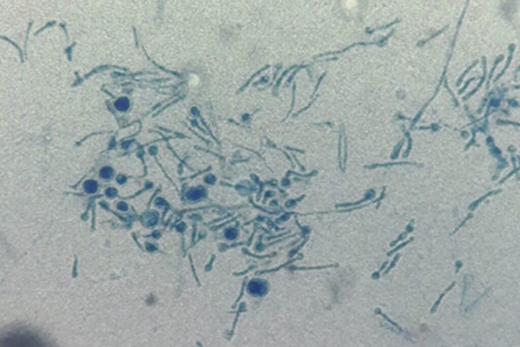First case of human infection with fungus - plant parasite - iMedia