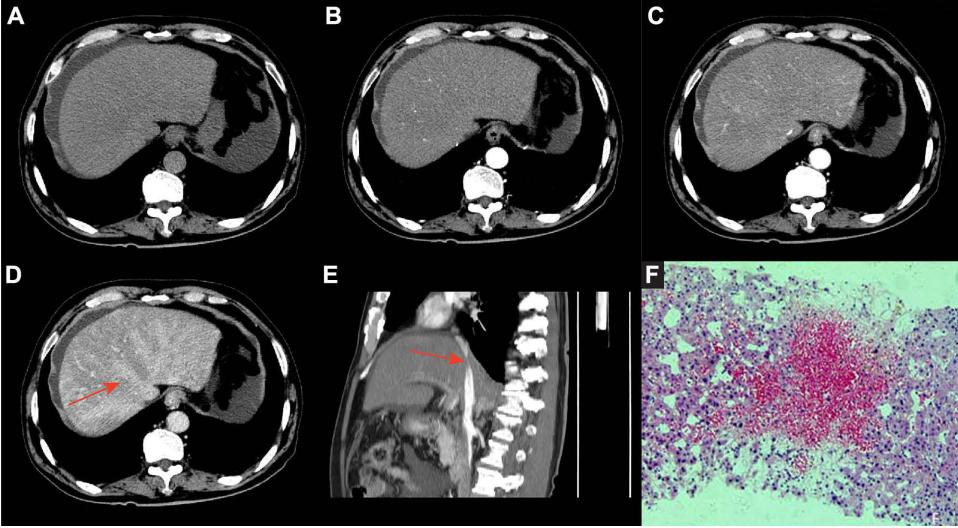 Clinical features and CT imaging analysis of hepatic sinusoidal ...