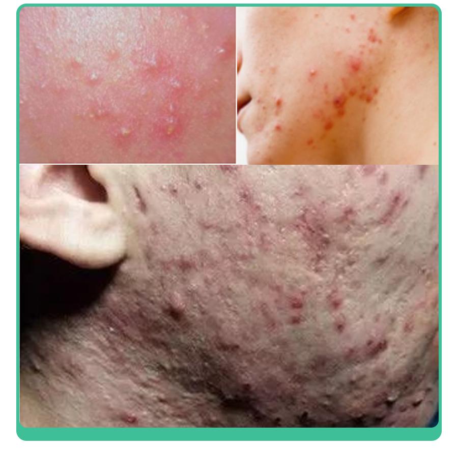 Acne or folliculitis?What is this pimple on a child?A picture to help ...