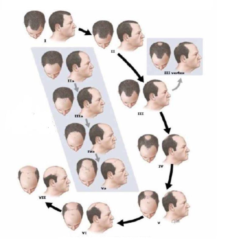 How to measure hair loss in men - iNEWS