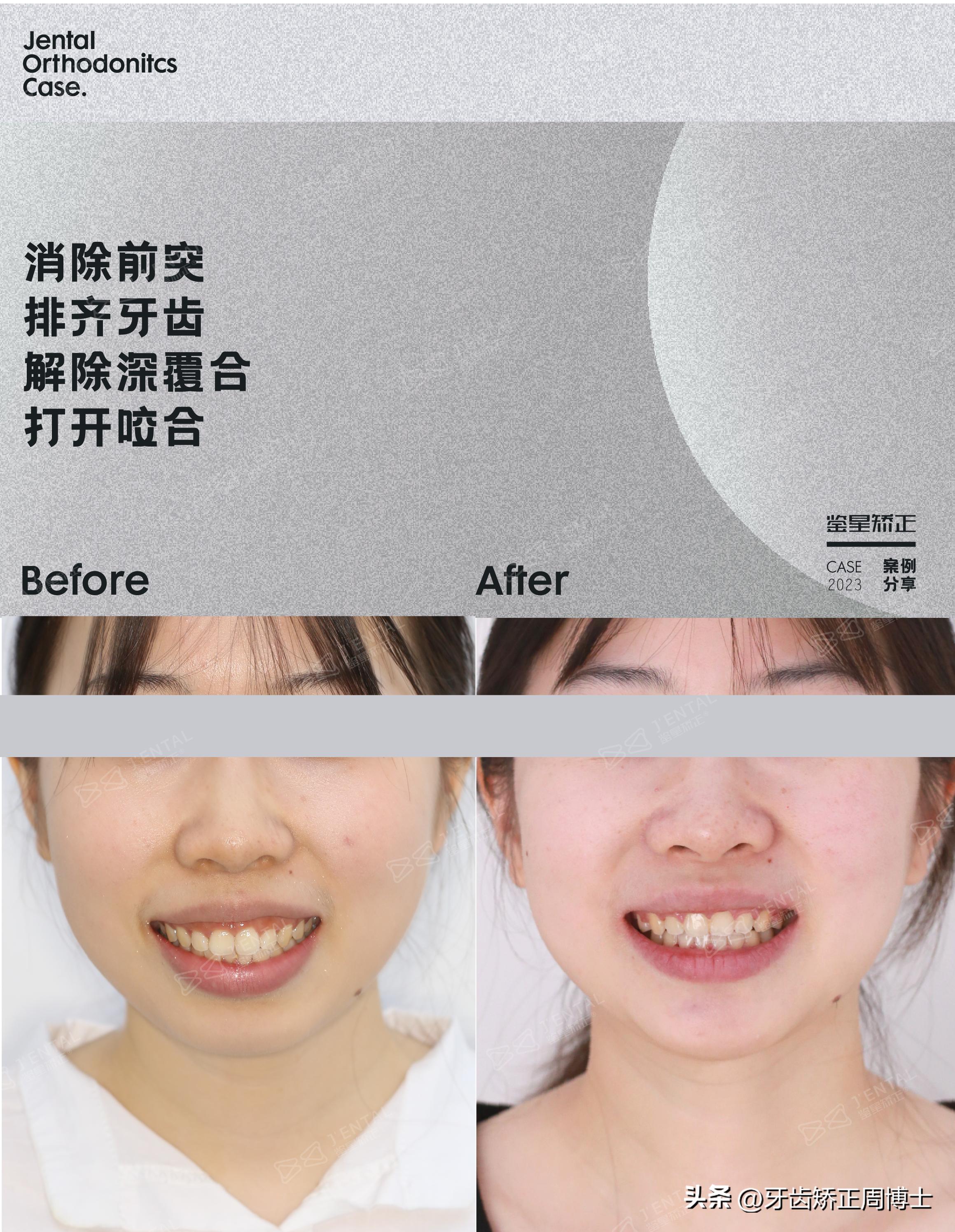 8 bone nails with upper and lower jaw reverse rotation, poor mandible ...