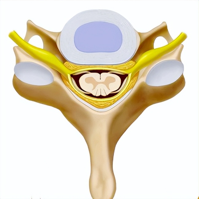 What are the consequences of a cervical disc herniation? - iNEWS