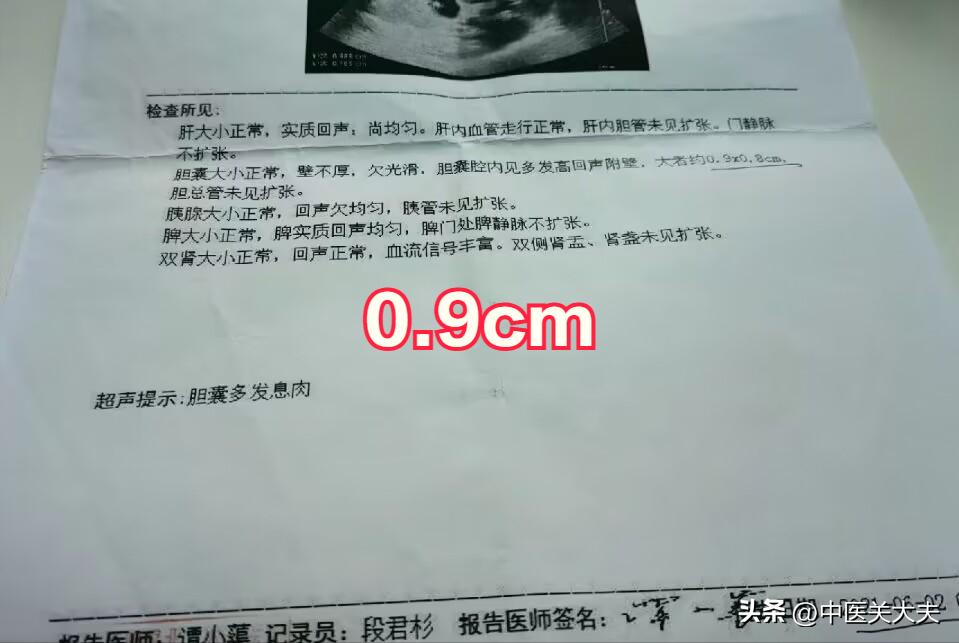 6-year history of gallbladder polyps, Chinese medicine treatment for ...