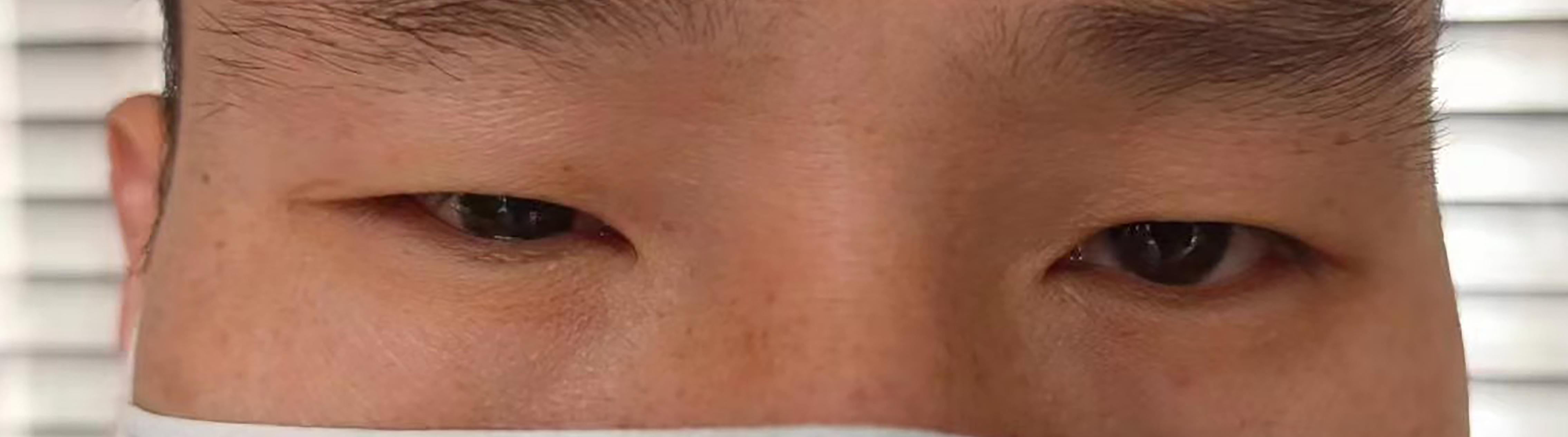 Congenital microphthalmia and poor eye condition, can I wear prosthetic ...