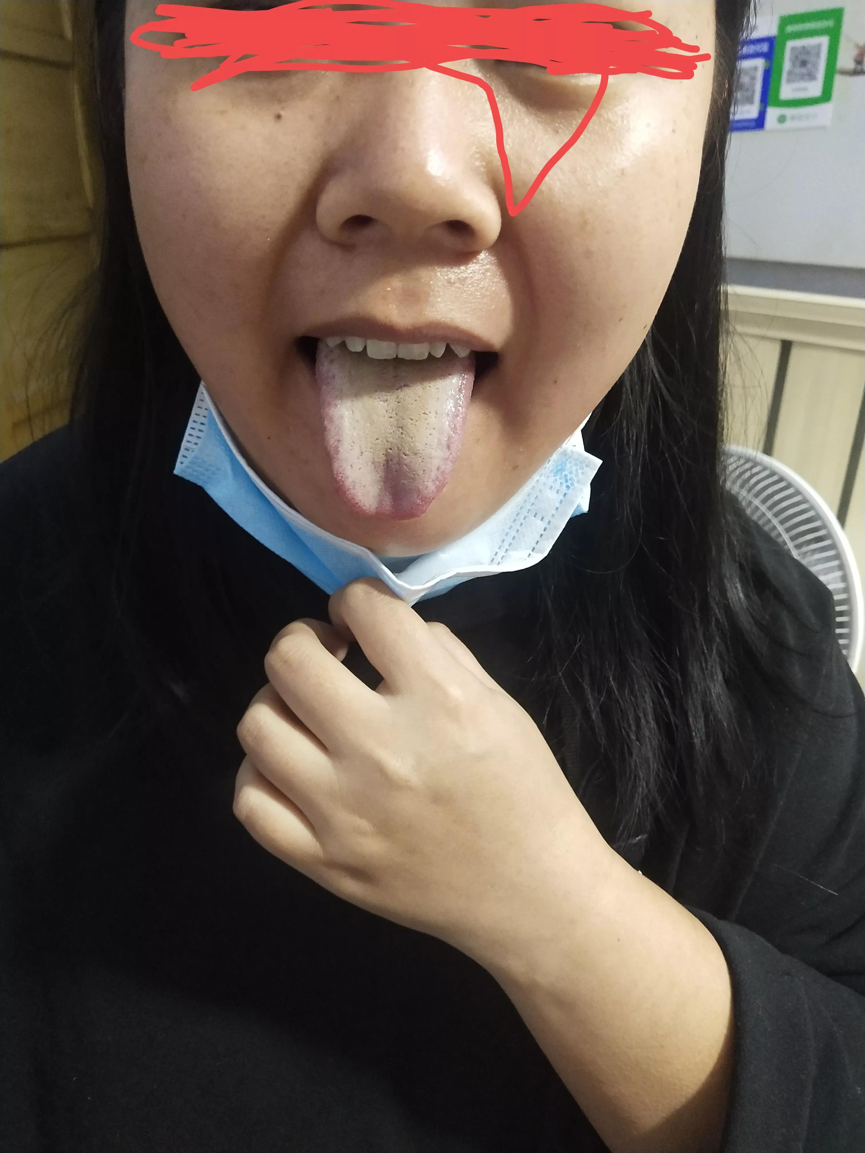 Treatment of thick and greasy tongue coating by nourishing yin - iNEWS