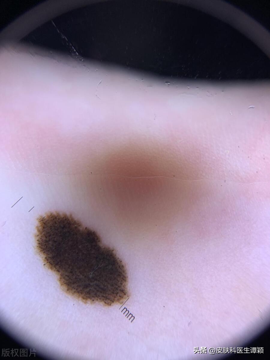 A dermatologist talks to you: What is a pigmented nevus? What ...