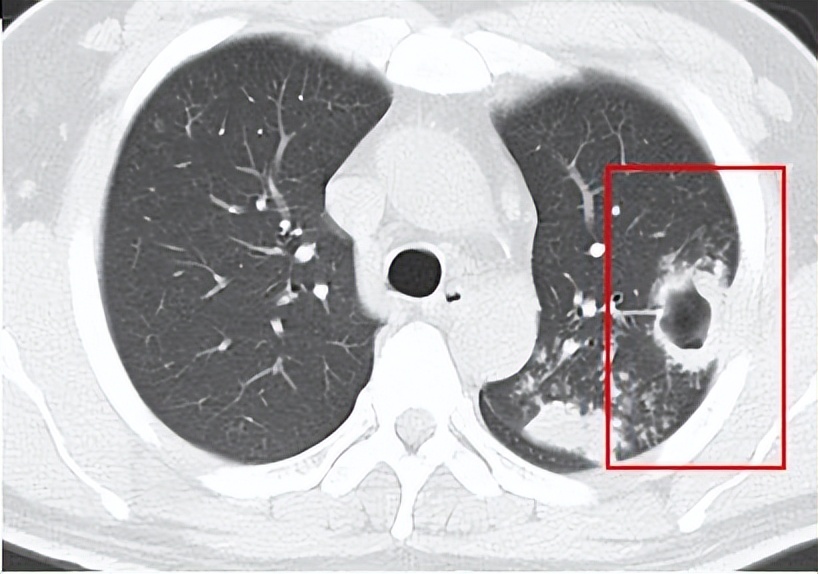 Imaging identification of chest cavity and cavity - iNEWS
