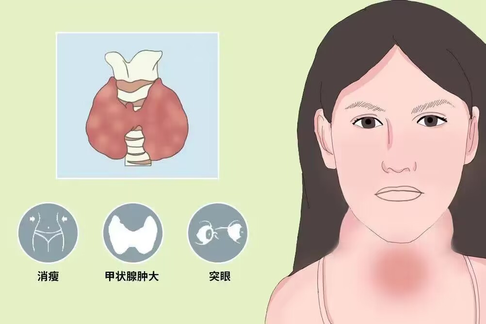 Thyroid is also overweight? It turns out that foot goiter - iNEWS