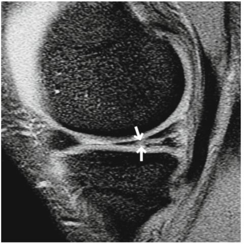 Magnetic resonance diagnosis of meniscus tear (3)-horizontal tear and ...