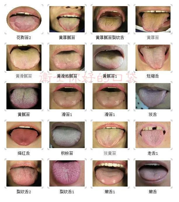 Tongue diagnosis is common in traditional Chinese medicine, which is ...