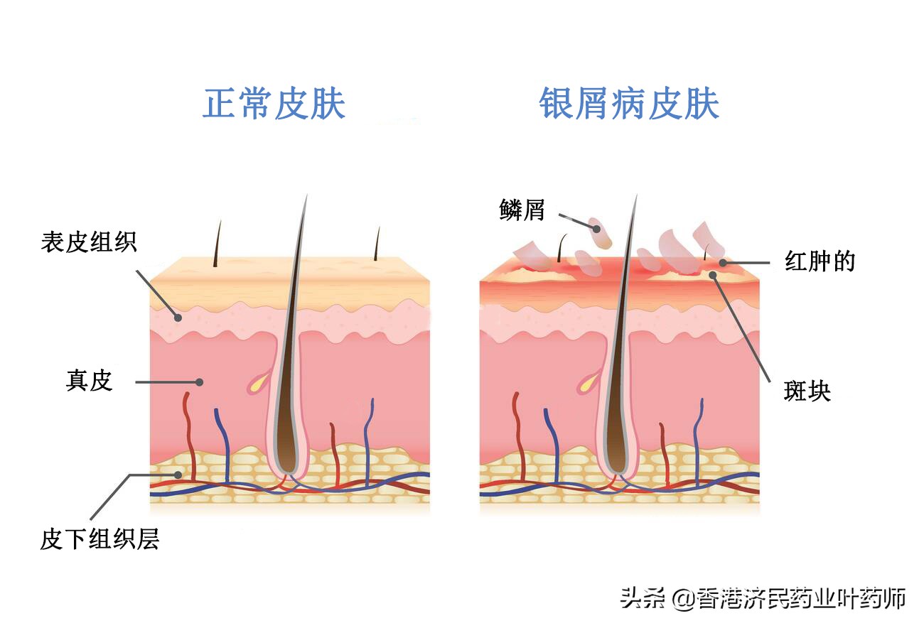 Steroid Free!FDA Approves VTAMA (tapinarof) Cream 1% for Plaque ...