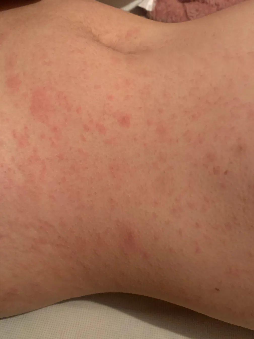 Generalized erythema multiforme, how to cause it? - iNEWS