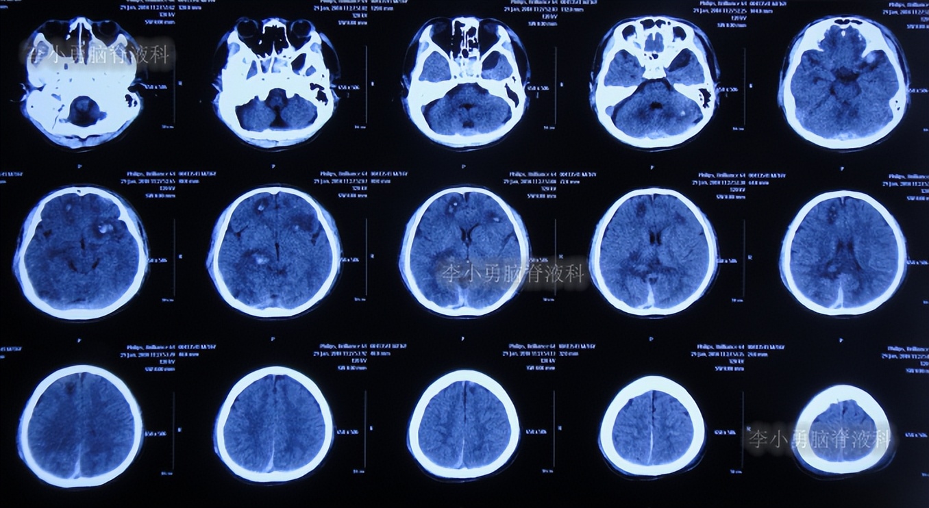 Car accident with multiple serious brain and body injuries and deep ...