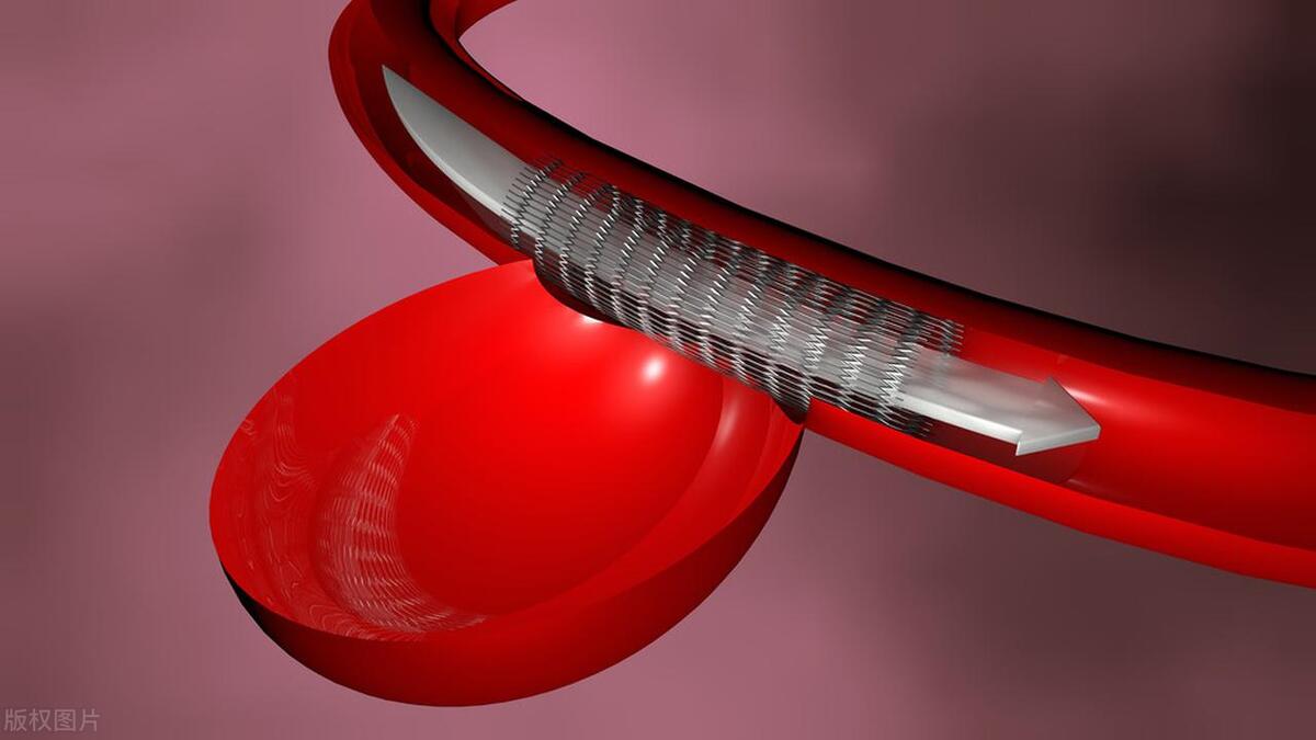 The heart is implanted with a stent to unblock the blood flow, why not ...