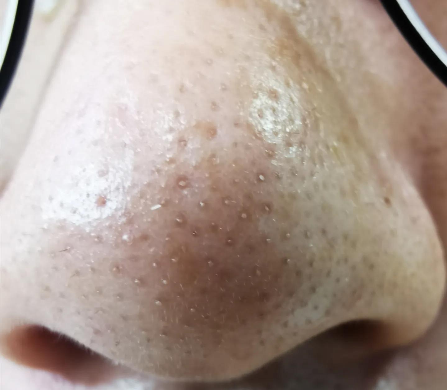 What are those little white particles that come out of my nose? - iNEWS