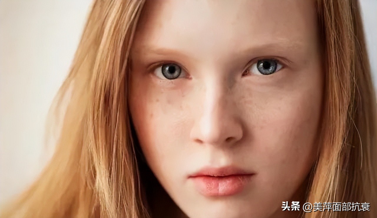 How do freckles form, and how can they be removed safely? - iMedia