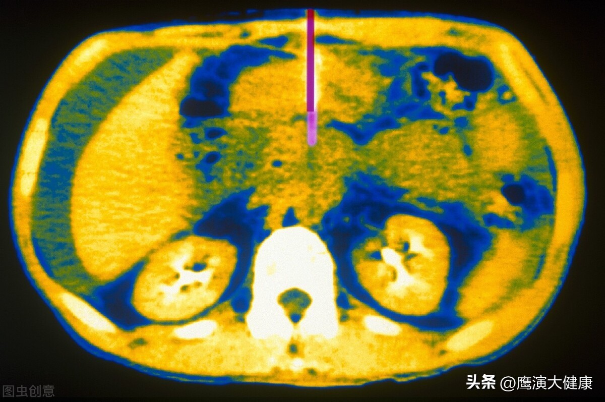 The 3 types of cancer are extremely occult, and most of them are ...