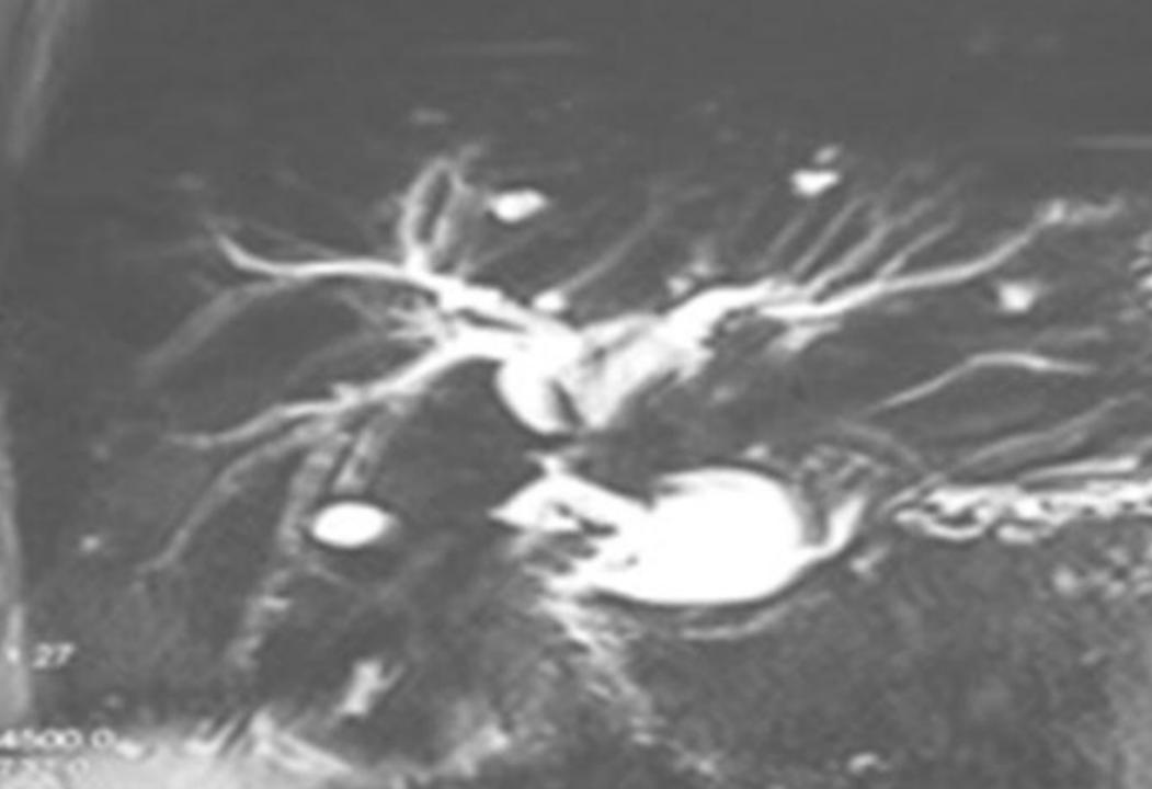 Popular science of MRCP - iNEWS