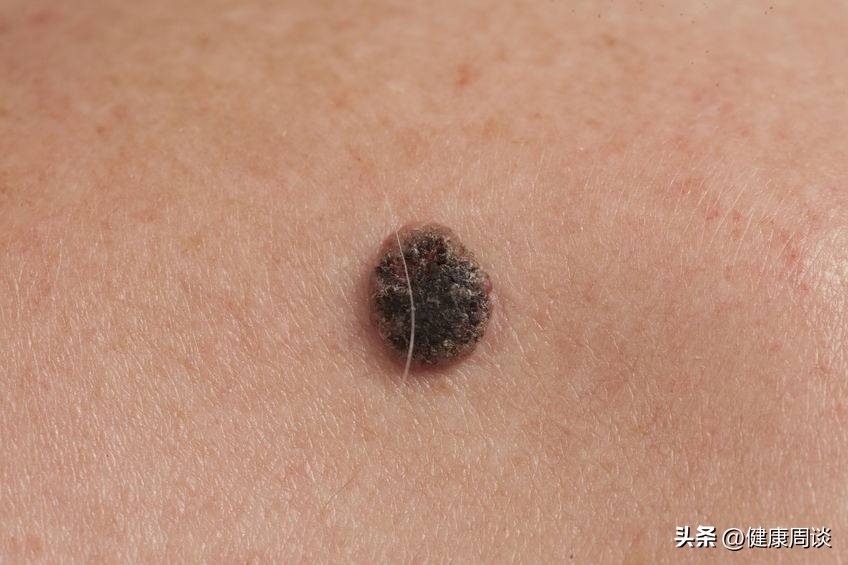 Reminder: There are good and bad moles, if any of these 5 abnormalities ...