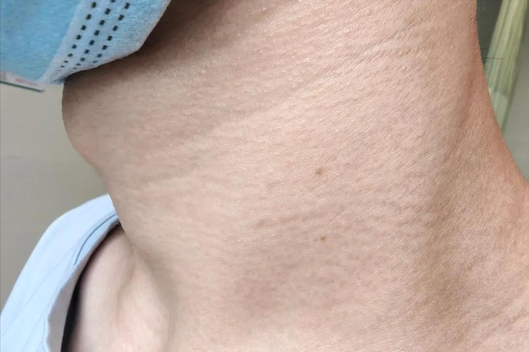 Meat bumps on the head and back, are they the same? - iNEWS