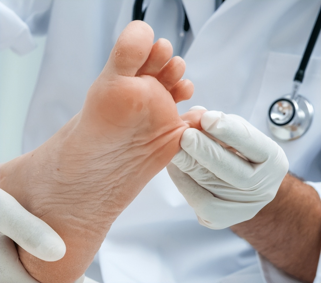 What to do if athlete's foot recurs? Teach you 2 practical methods to ...
