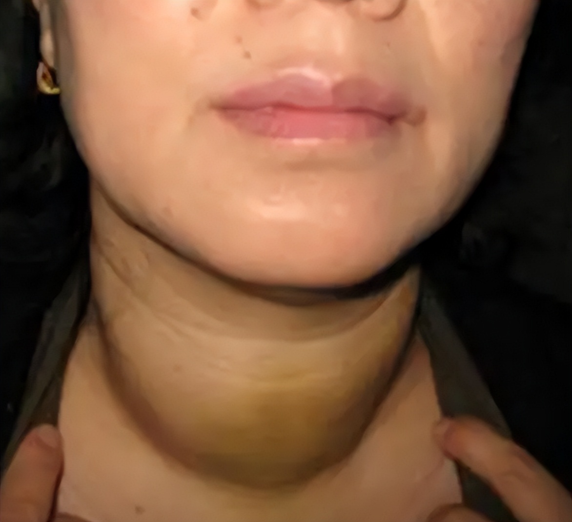 Learn about "Hashimoto's Thyroiditis" in three minutes - iNEWS