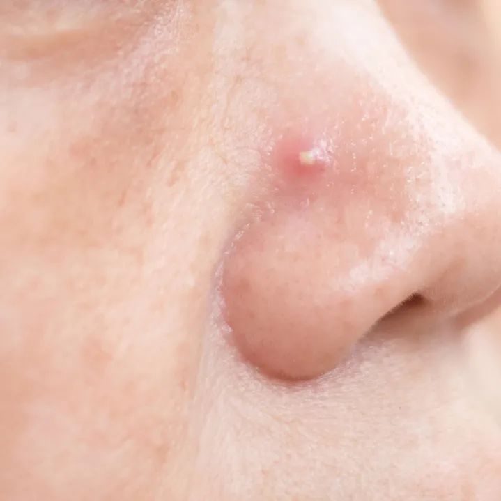 How to deal with the challenges of fragile and sensitive skin in the ...