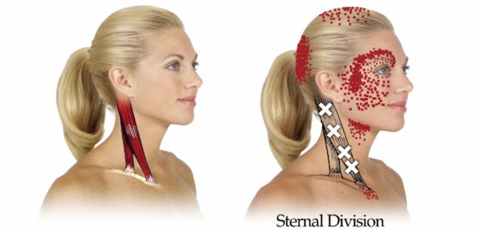Sternocleidomastoid – a muscle that everyone with neck pain should ...
