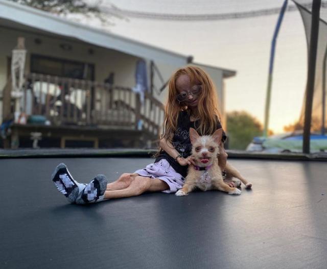 Well-known Internet celebrity Adalia Ross died of progeria at the age ...