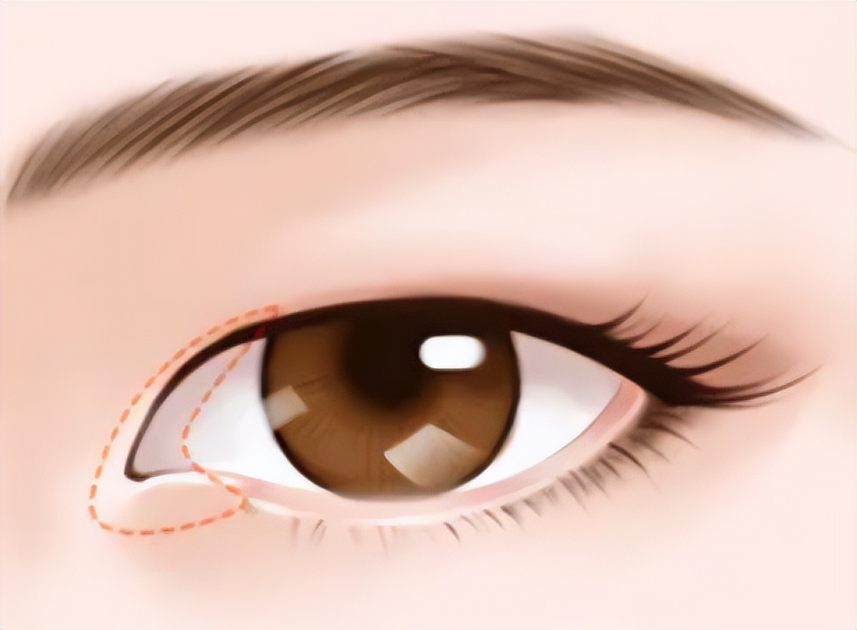 The distance between the eyes is close, can the inner corner of the eye ...
